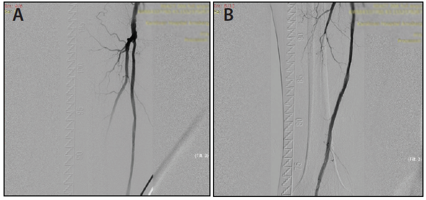 Case Report: Low-Profile Crossing and Stenting of a Long SFA Occlusion ...