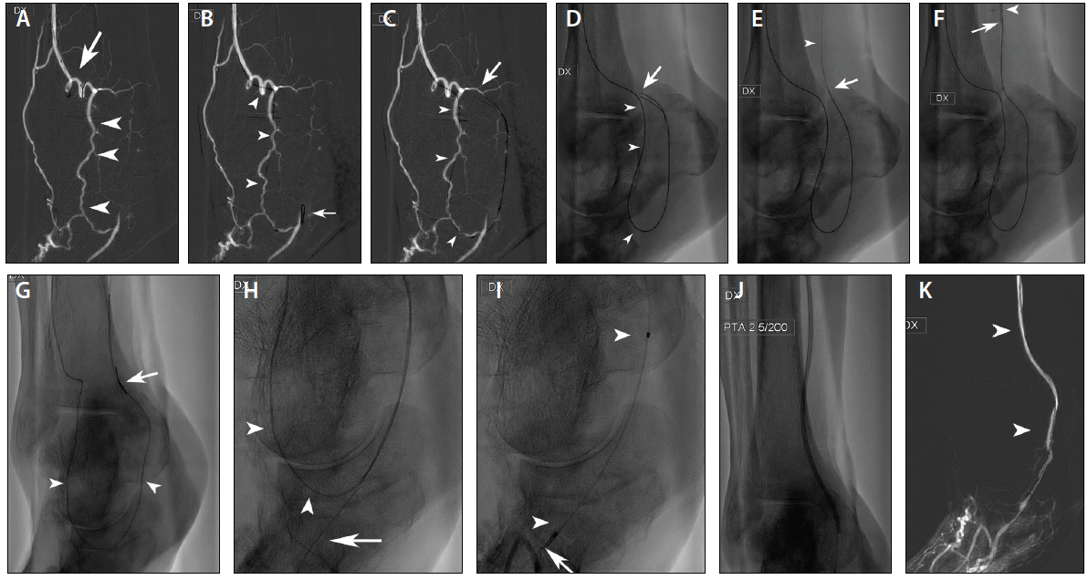 Case Report: Revascularizing BTK Occlusions Using the Carnelian Support ...