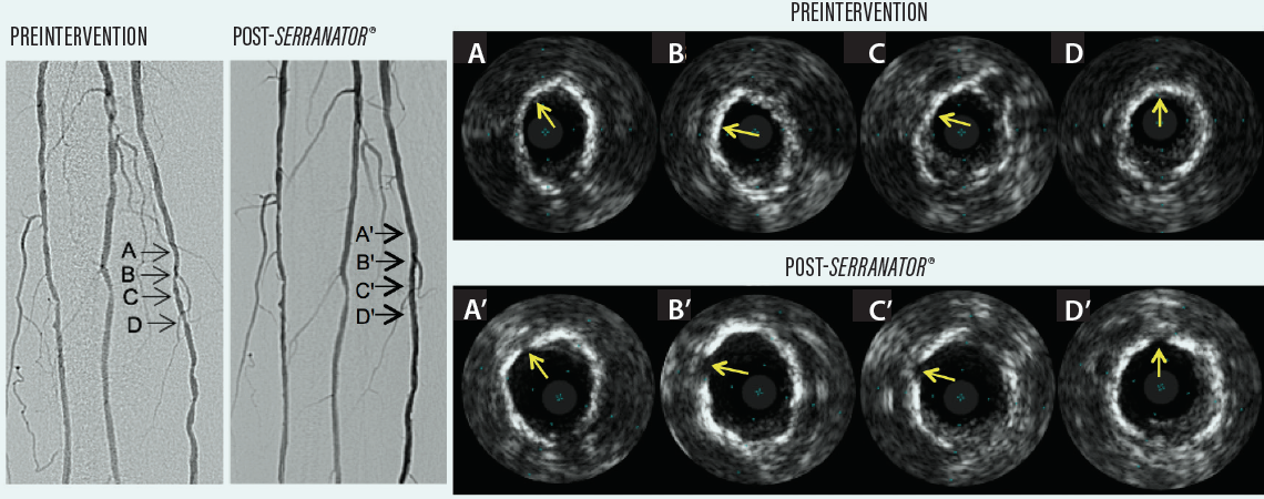 Exploring Serration-Enhanced BTK Angioplasty - Endovascular Today