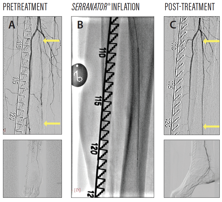 Exploring Serration-Enhanced BTK Angioplasty - Endovascular Today