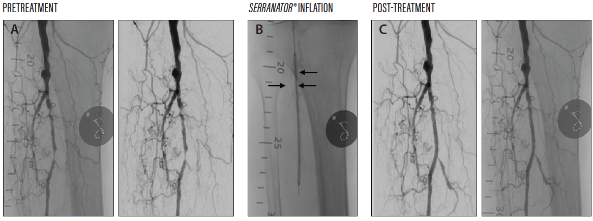 Exploring Serration-Enhanced BTK Angioplasty - Endovascular Today