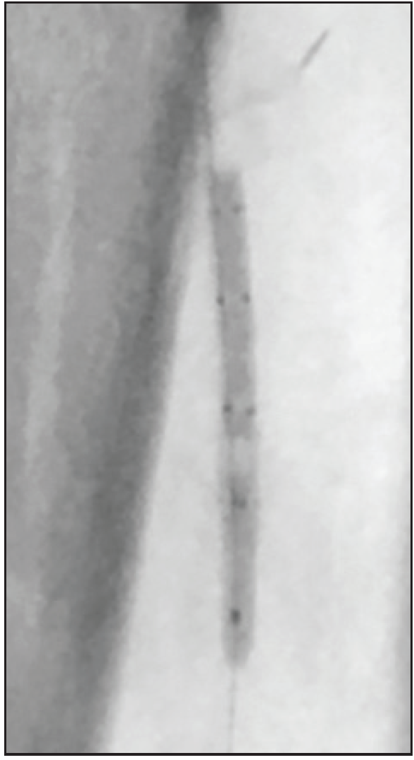 Case Study: Navigating BTK Revascularization in the Epicenter of a ...