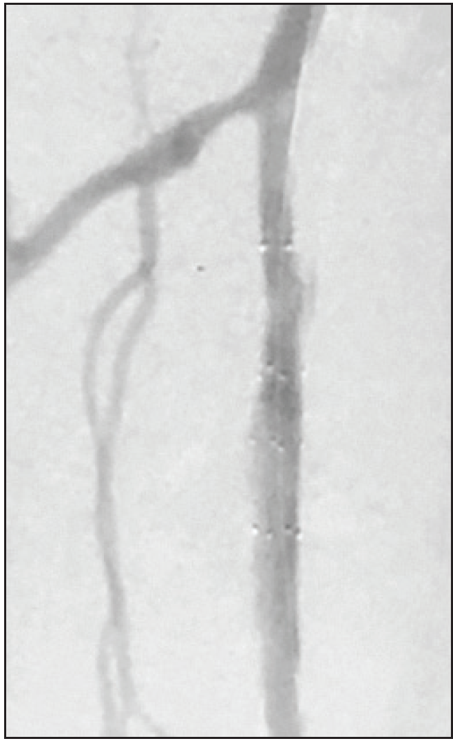 Case Study: Navigating BTK Revascularization in the Epicenter of a ...