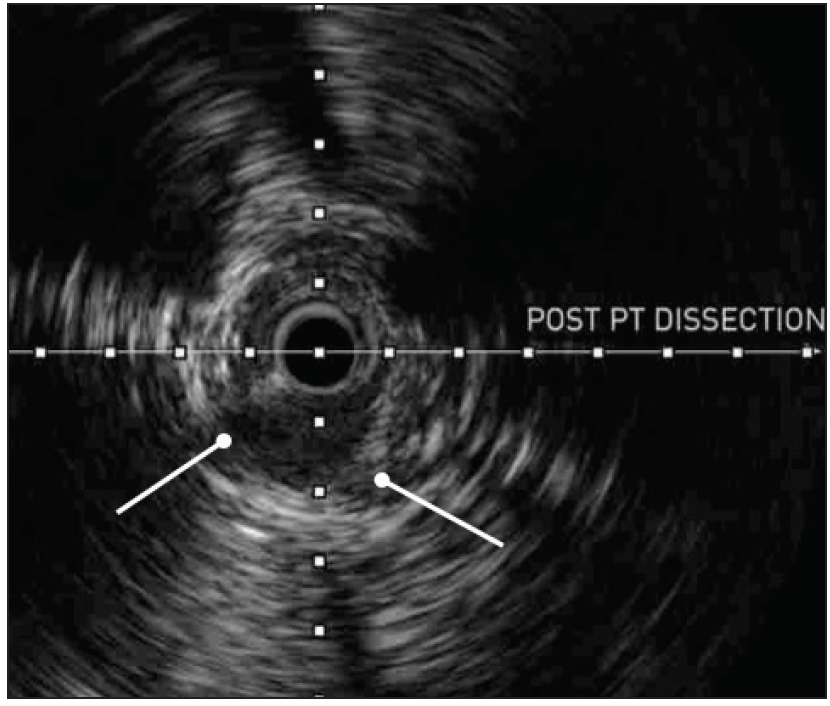 Case Study: Tibial Artery Dissection Repair During the Pandemic ...
