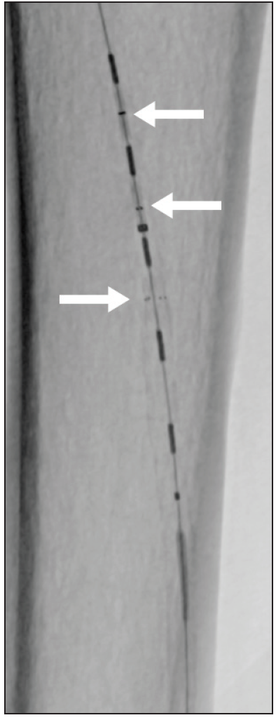 Case Study: Tibial Artery Dissection Repair During the Pandemic ...
