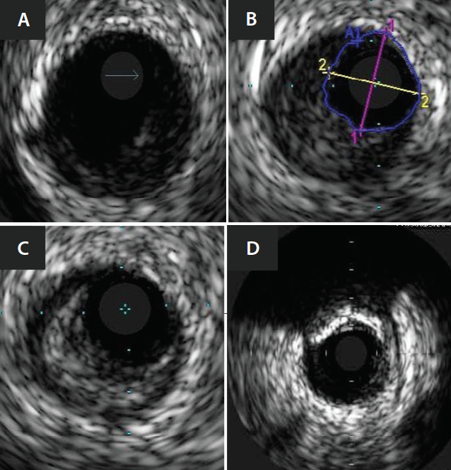 The Four Pillars of IVUS for the Endovascular Treatment of CLI ...