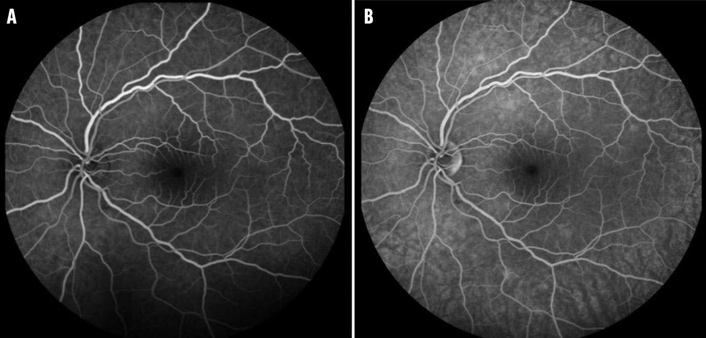 A Case of MEWDS Following COVID-19 Infection - Retina Today