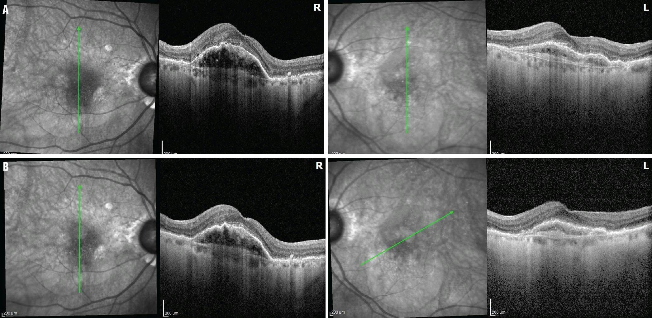 Integrating Next-Generation Wet AMD Therapies - Retina Today
