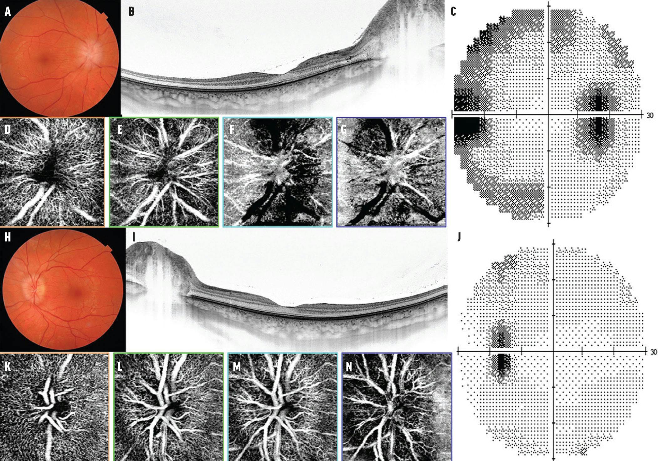 Evaluating the Threat of Bilateral Stasis - Retina Today