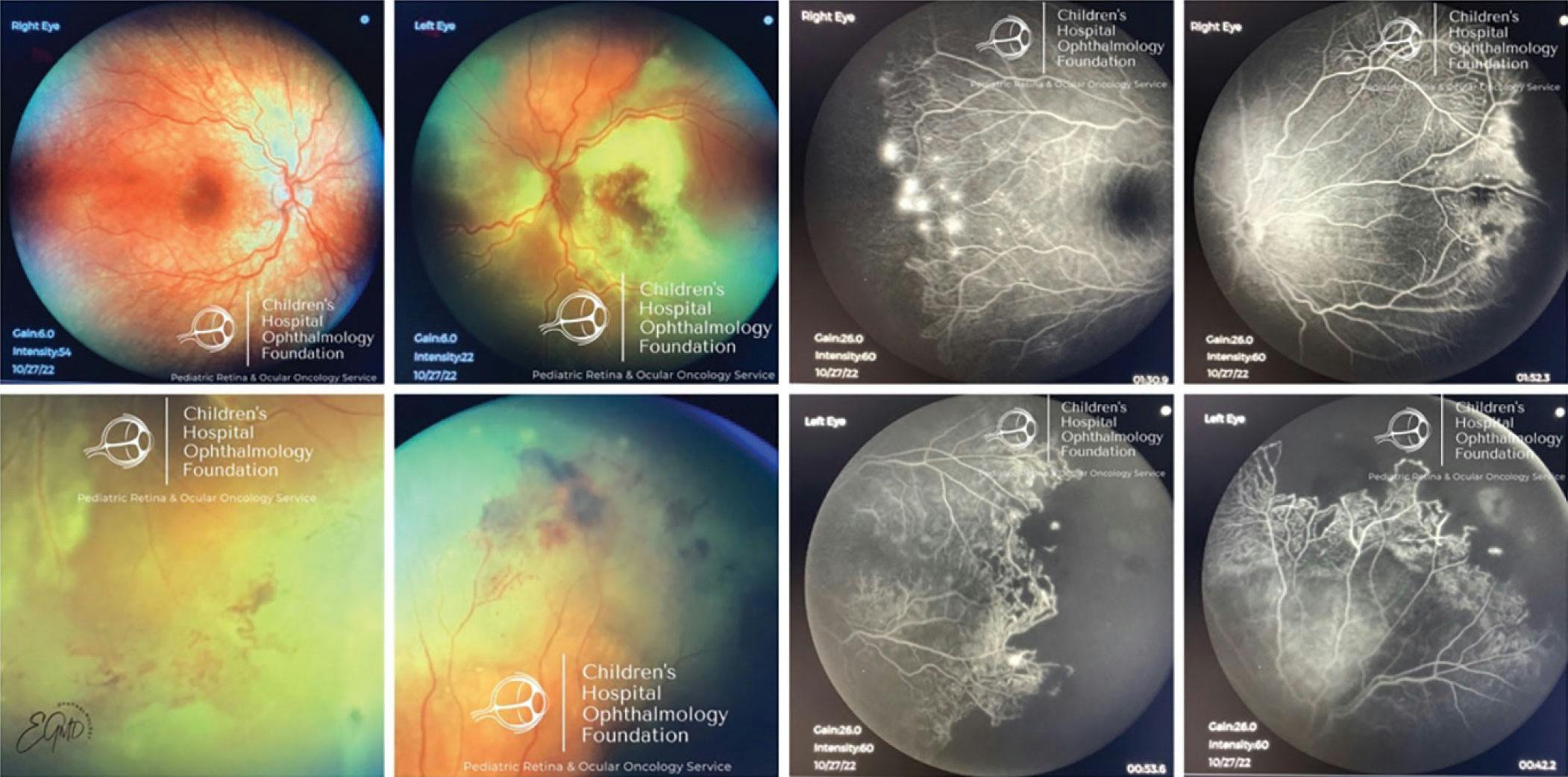 Pediatric Retina Fellowship: A First of its Kind - Retina Today