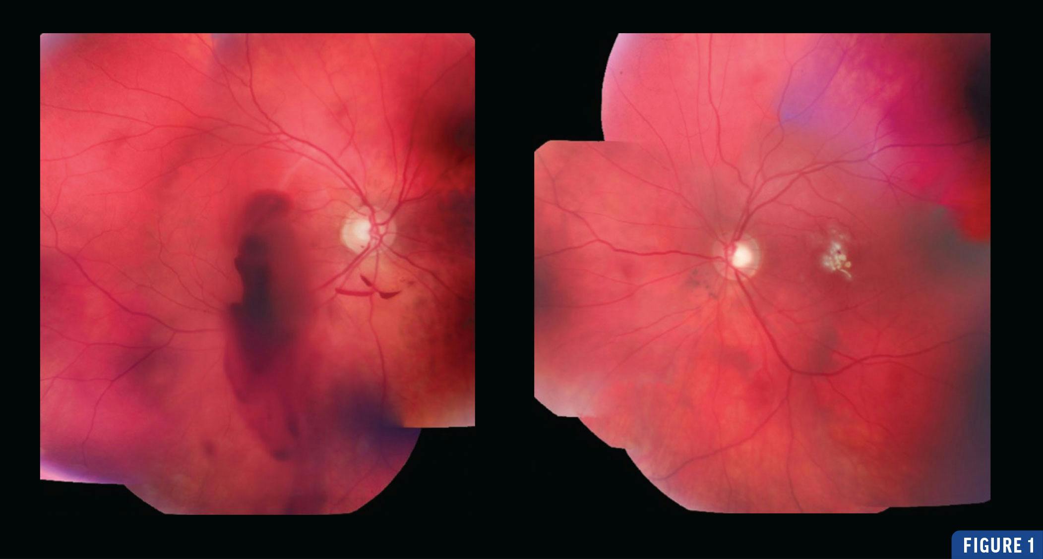 Self-Inflicted Laser-Induced Retinopathy - Retina Today