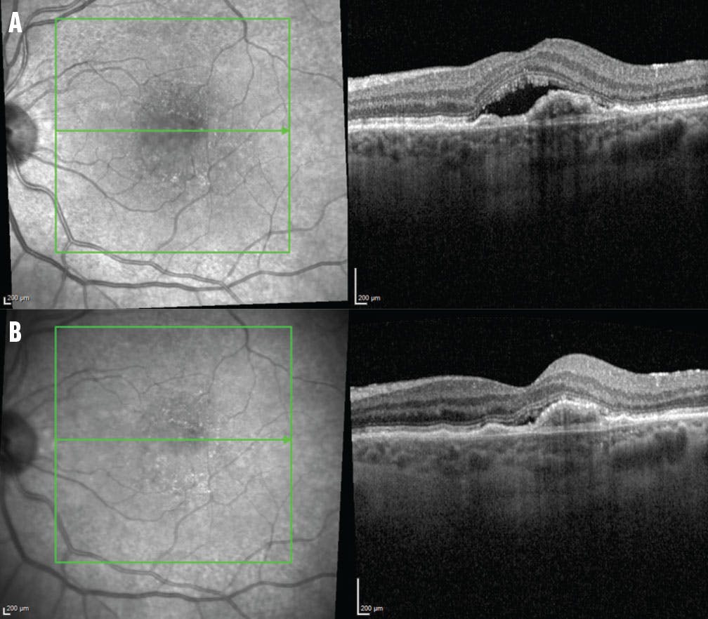 Emerging (Durable) Therapies for Wet AMD - Retina Today