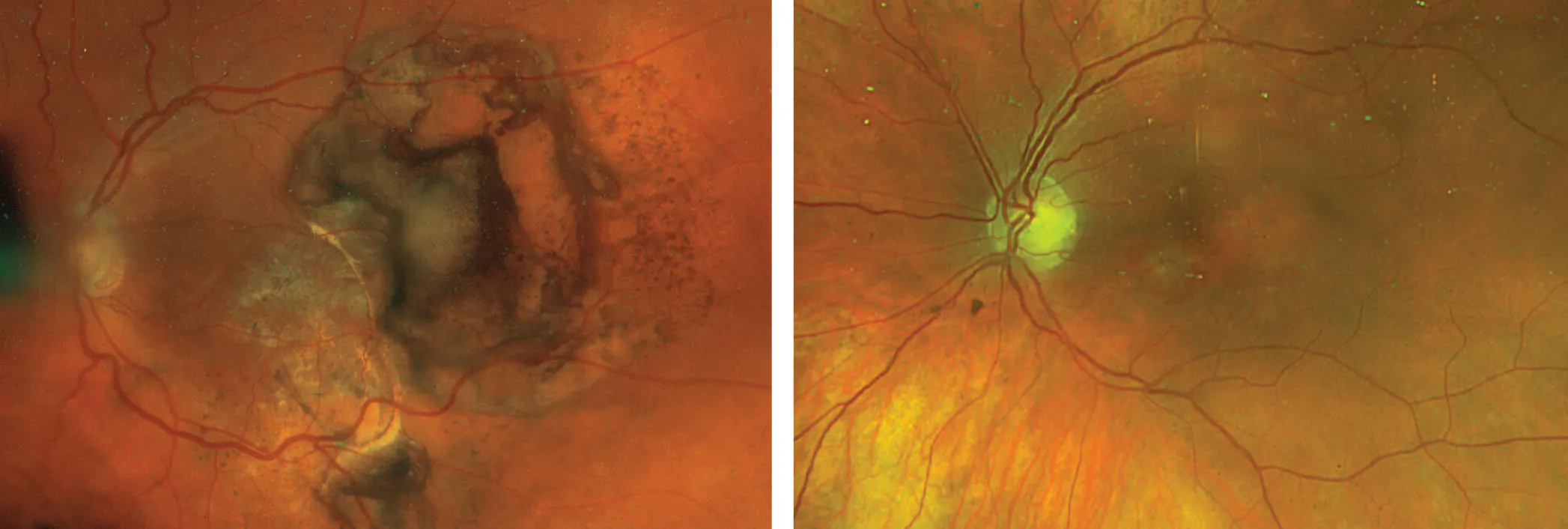 Gene Therapy for AMD: What You Need to Know - Retina Today