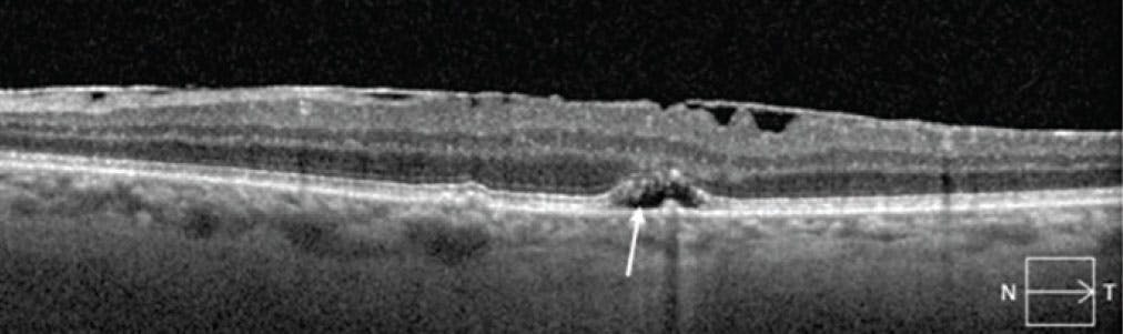 Imaging Biomarkers for GA Progression - Retina Today