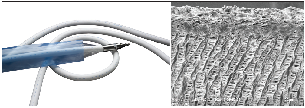 The Flixene Vascular Graft as an Early Access Arteriovenous Solution ...