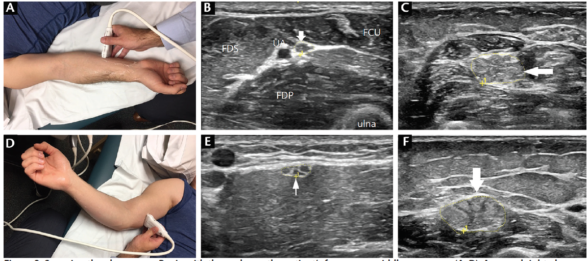Neuromuscular Notes: Neuromuscular Ultrasound in Polyneuropathy ...