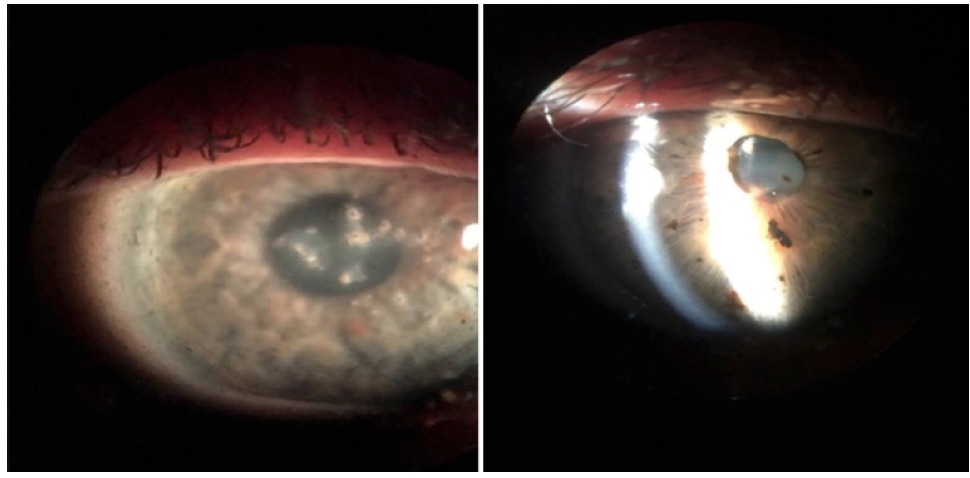 Eye Trauma Contact Lenses