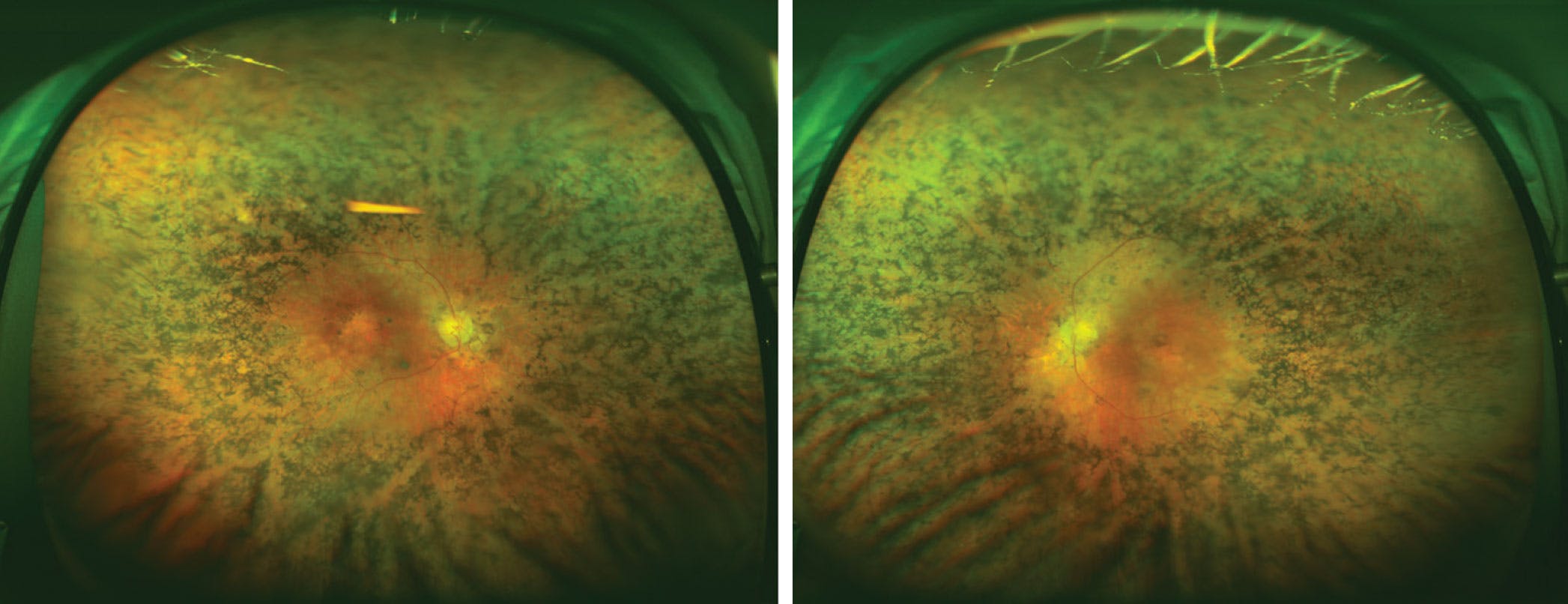 Navigating Inconclusive Testing in IRD - Retina Today