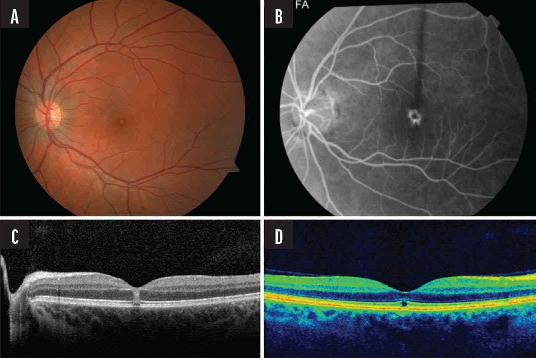 Solar Retinopathy: Eyes on an Eclipse - Retina Today