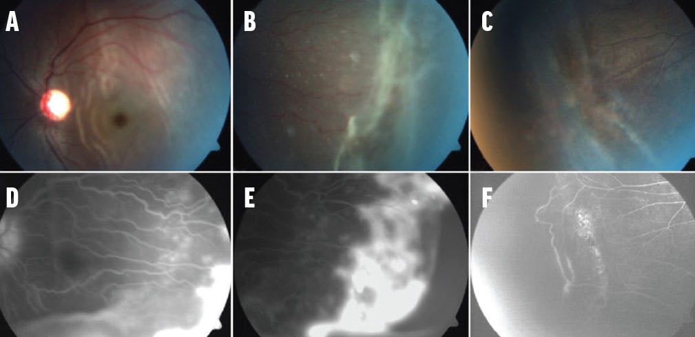Pediatric Retinal Detachment Associated With FEVR - Retina Today