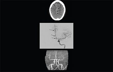 Headache Horizons: Reversible Cerebral Vasoconstriction Syndrome ...
