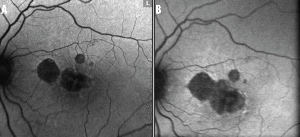 A Series of Rare Events in Geographic Atrophy Therapy - Retina Today