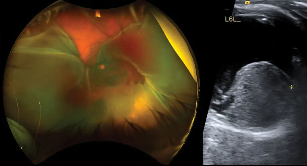 Surgical Management of Retinal Detachment in Uveal Melanoma - Retina Today