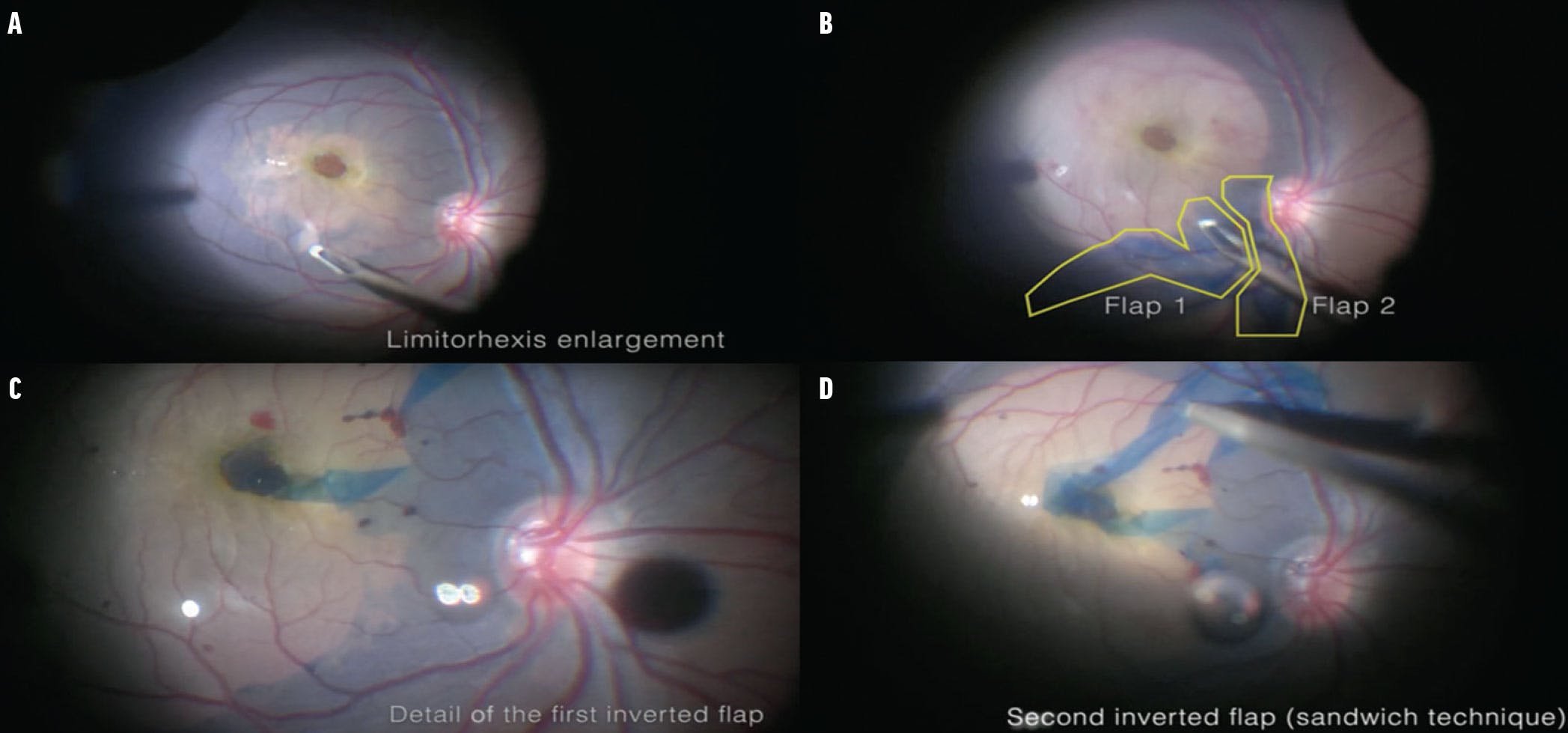 Doubling Down on Traumatic Macular Hole Management - Retina Today