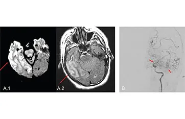 Neurosyphilis Mri Full Article: Clinical Insights Into Neurosyphilis