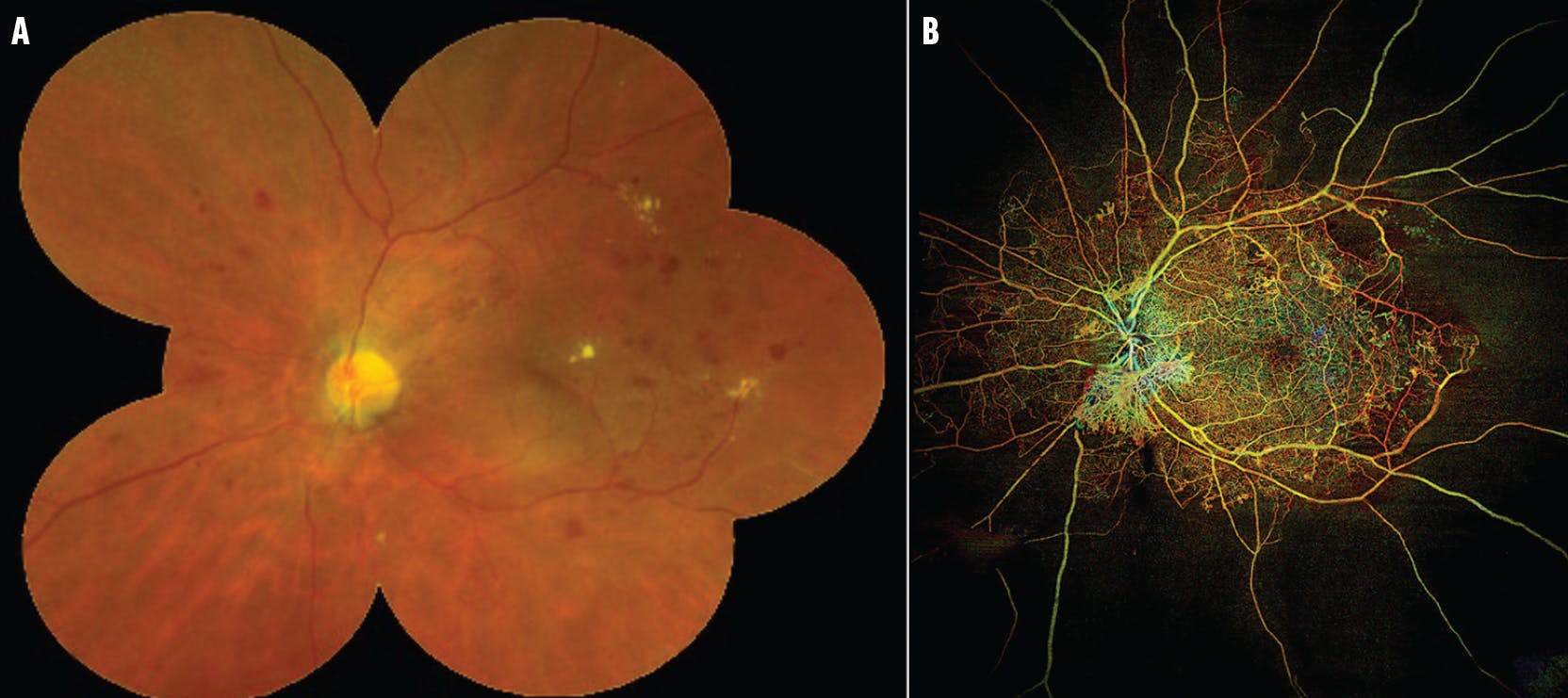 Widefield OCTA: A New Way to Stage Diabetic Retinopathy - Retina Today