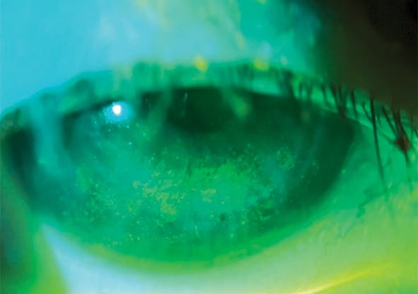 All About That Blink - Modern Optometry