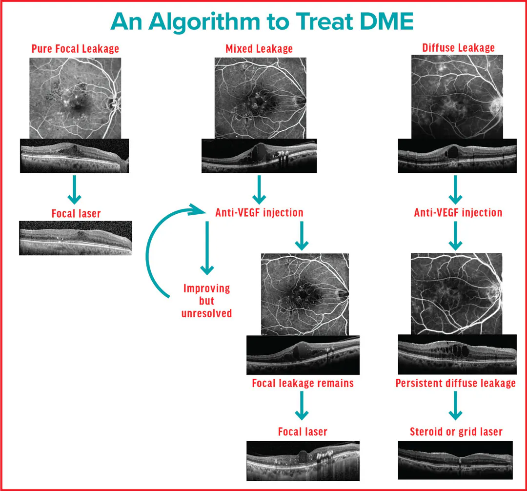 An Algorithmic Approach to DME - Retina Today