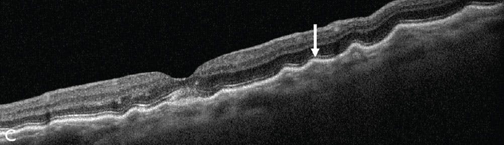 맥락막 주름choroidal Fold 맥락망막 주름 Chorioretinal Fold 네이버 블로그