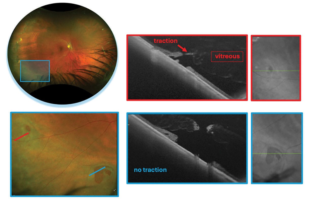 Pearls for Imaging the Peripheral Retina - Retina Today
