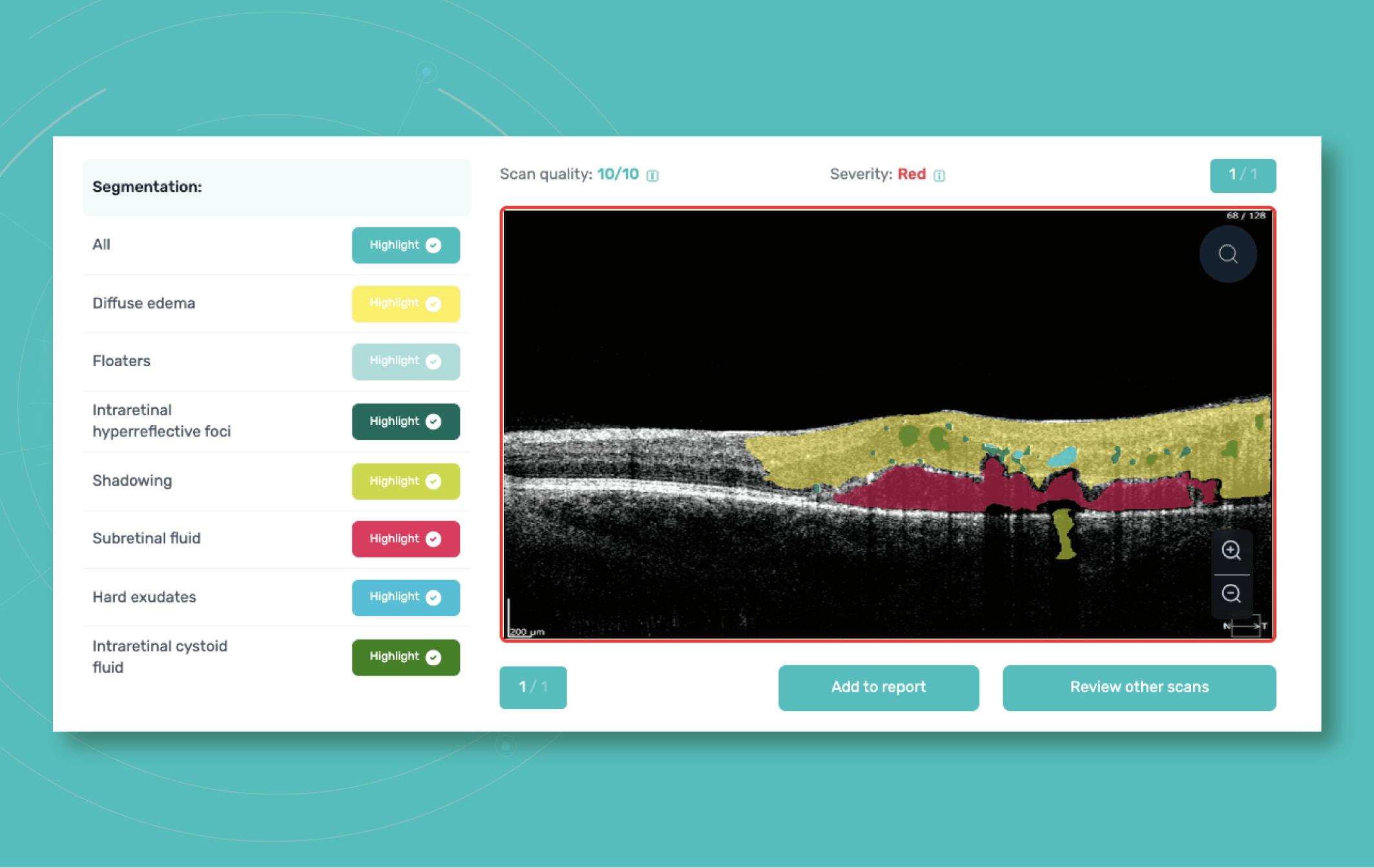 Altris Receives FDA Clearance of Altris IMS Platform for OCT Scan Analysis - Eyewire+