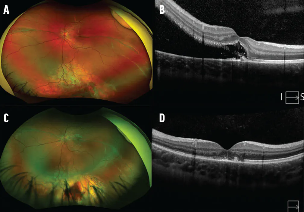Pediatric Vitreoretinal Surgery Tips - Retina Today