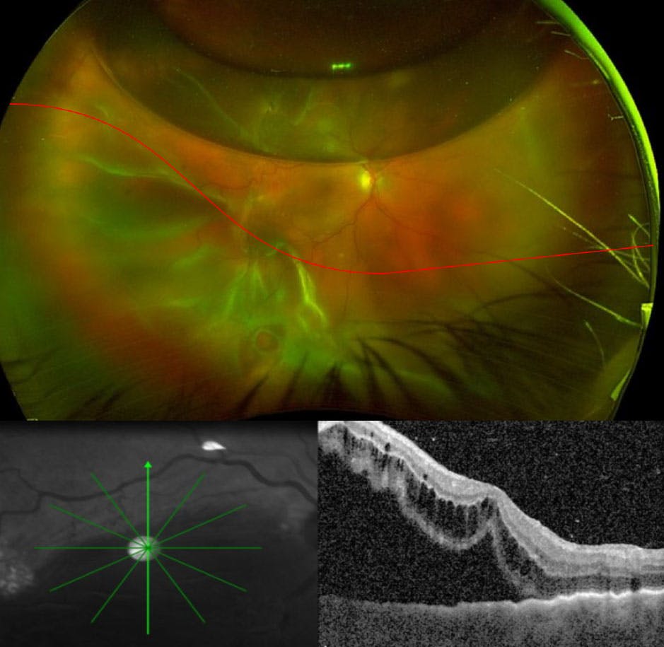 Advice From the OR: RD and PVR - Retina Today