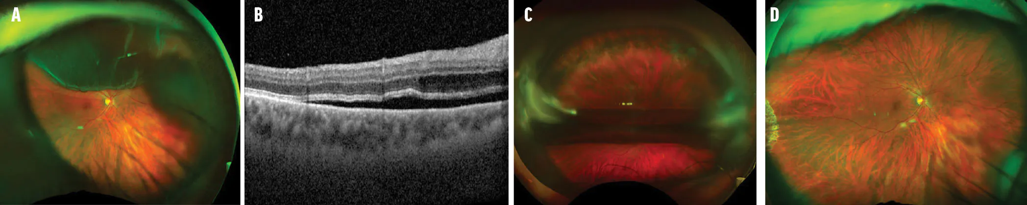 Head Positioning after RD Surgery: A Review - Retina Today