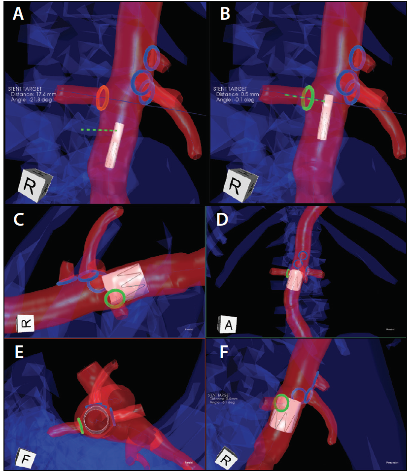 A Revolution of EVAR Imaging Technologies - Endovascular Today
