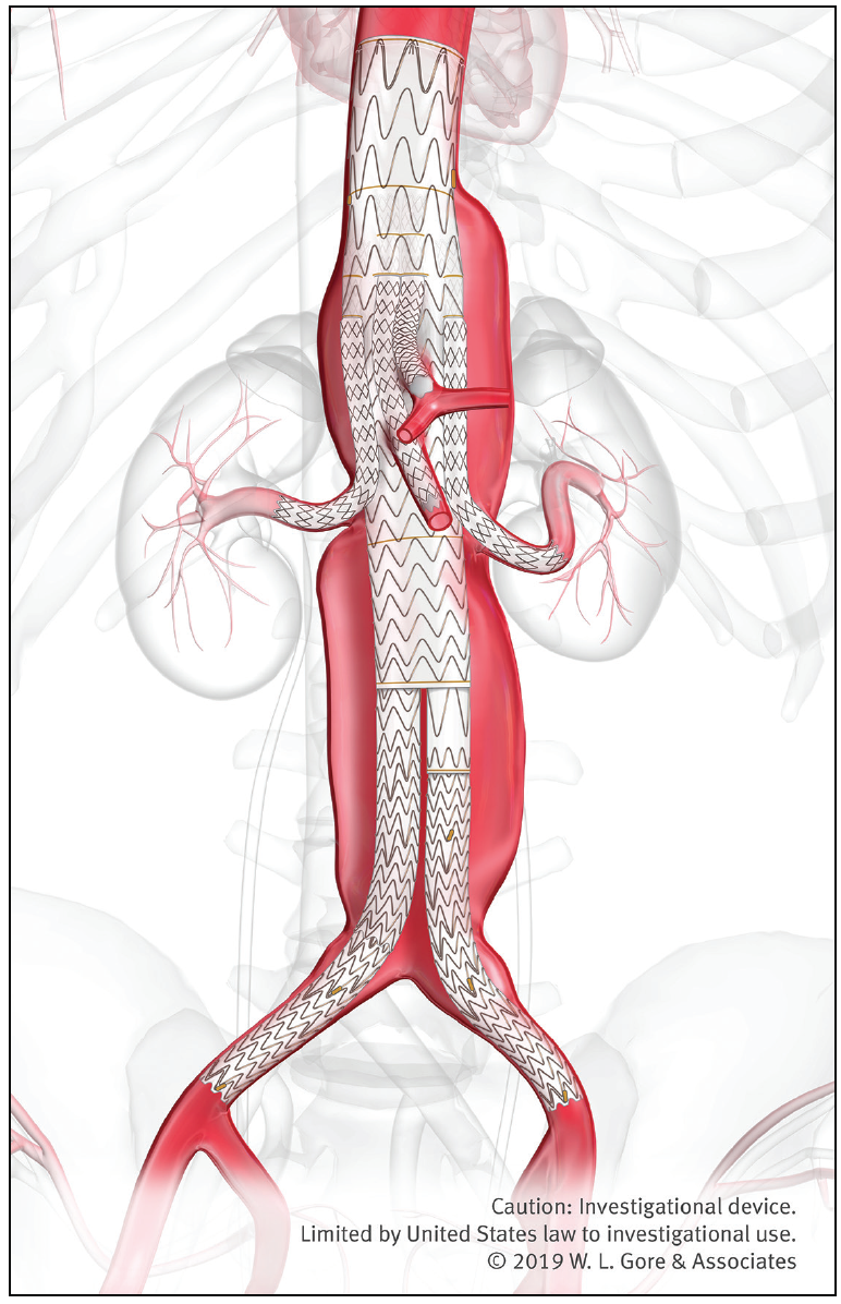 New Devices on the Frontier for Off-the-Shelf Repair of TAAAs ...