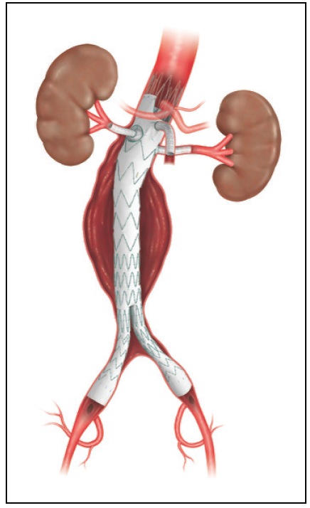 New Devices on the Frontier for Off-the-Shelf Repair of TAAAs ...