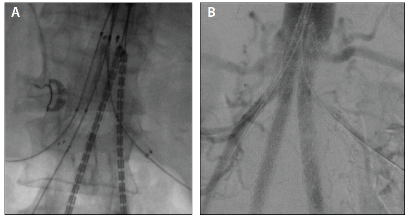 ChEVAS: Exploring Off-the-Shelf Repair of Thoracoabdominal Aneurysms ...