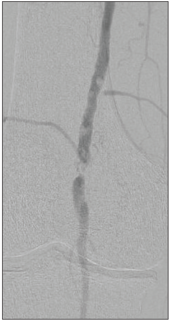 Transbrachial Access for Stenting of Femoropopliteal Lesions ...