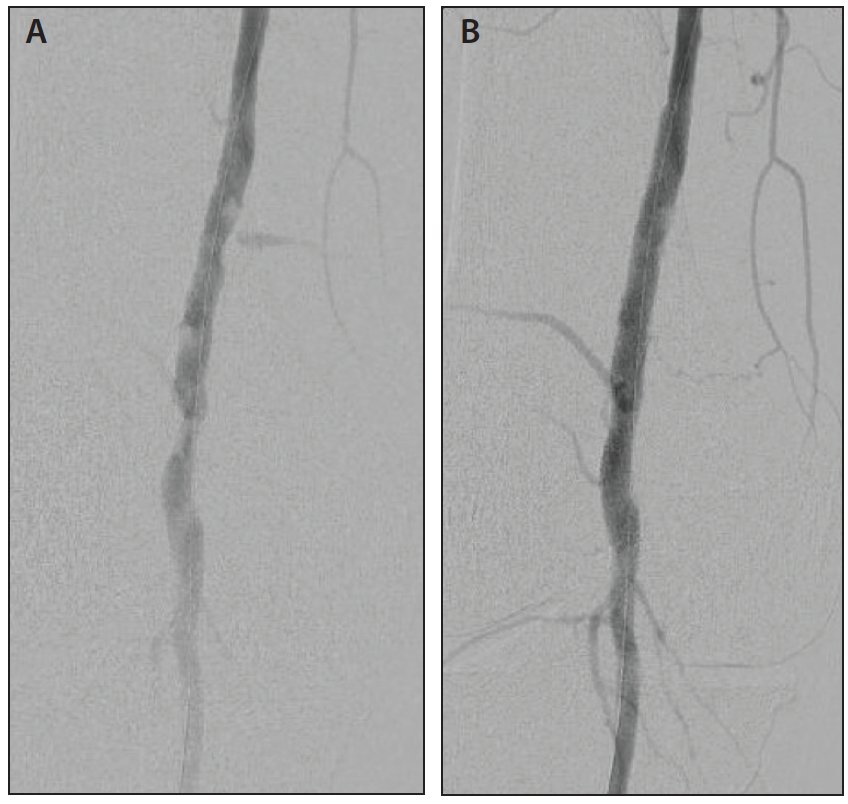 Transbrachial Access for Stenting of Femoropopliteal Lesions ...