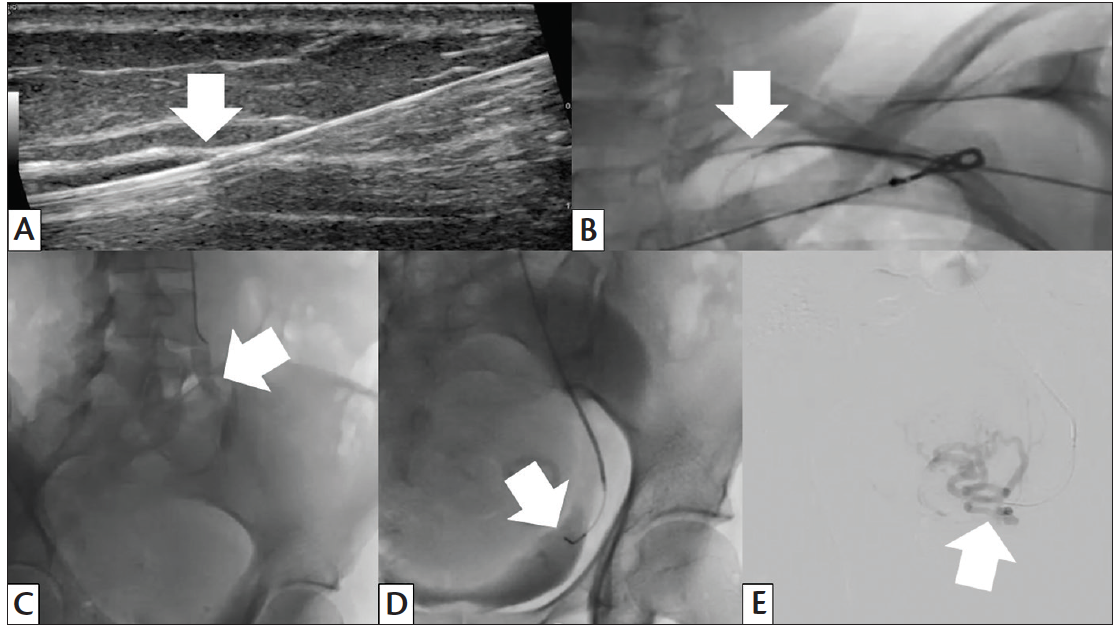 The Rise of Transradial Access for Embolization - Endovascular Today