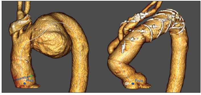 Arch Disease: Pathology and Treatment Strategies - Endovascular Today