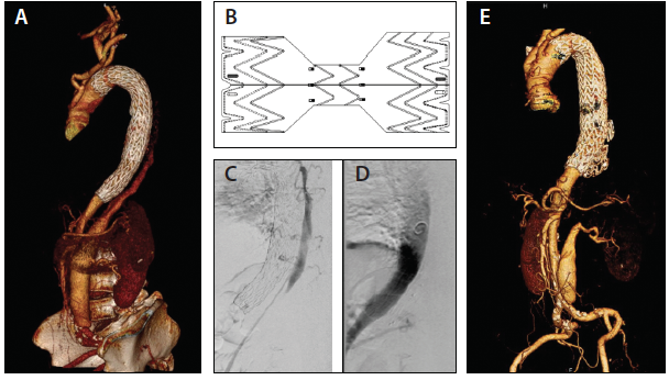 Endovascular Treatment of Arch and Descending Aortic Pathologies ...