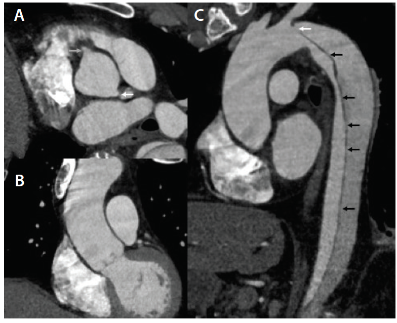 Imaging for TBAD: Essential and Optimal Techniques - Endovascular Today