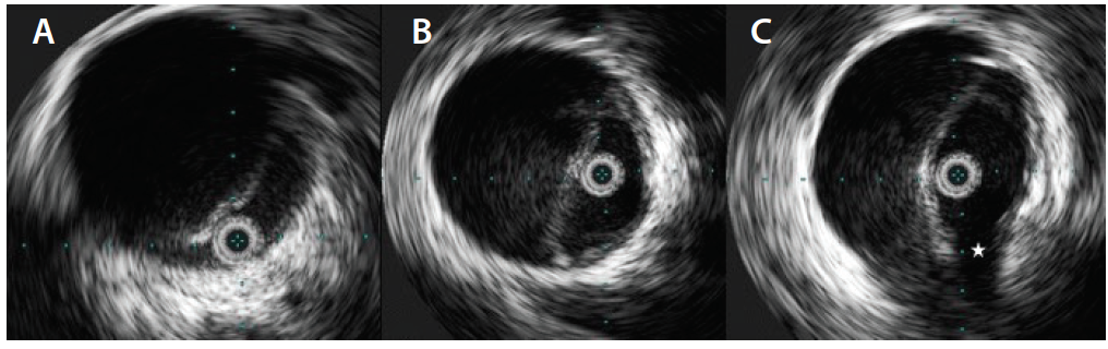 Imaging for TBAD: Essential and Optimal Techniques - Endovascular Today