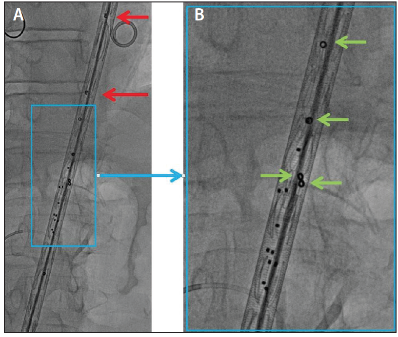 E-xtra DESIGN ENGINEERING: Inner Branch Technology - Endovascular Today